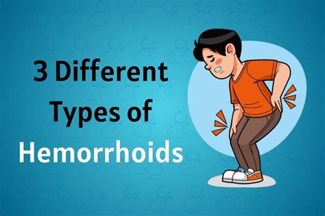 External Hemorrhoids Vs Skin Tags