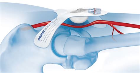 Safeguard Radial™ Compression Device By Merit