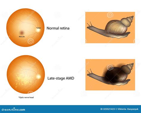 Age Related Macular Degeneration Or Amd Late Stage Amd And Normal Retina Stock Vector