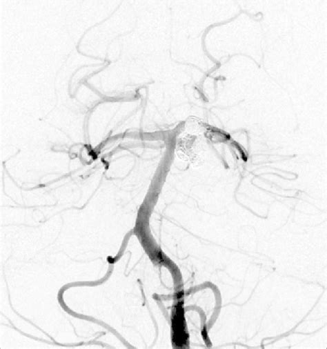 Four Years After The Second Coil Embolization Cerebral Angiography Download Scientific Diagram