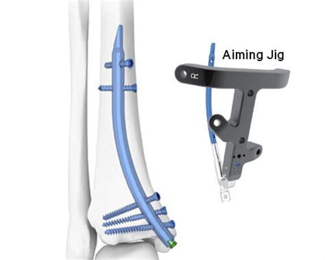 Distal Tibial Nail Aosys