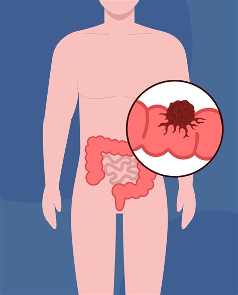 Colon Cancer Overview