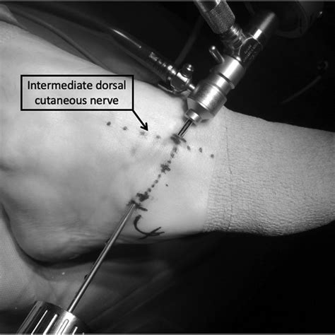 The First Point Of Inspection Is The Fourth Tarsometatarsal Tmt Joint Download Scientific