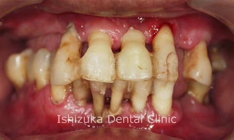 歯茎 色歯茎 健康