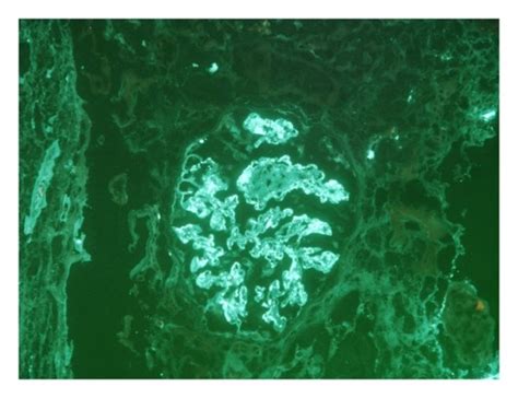 A Glomerulus With Nodularity Mesangial Hypercellularity And Download Scientific Diagram