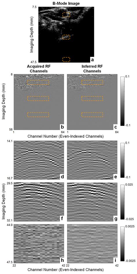 A B Mode Image Of Human Carotid In Vivo And The Corresponding