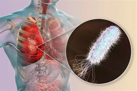 Can Pneumonia Cause Sepsis Understanding The Risks And Complications