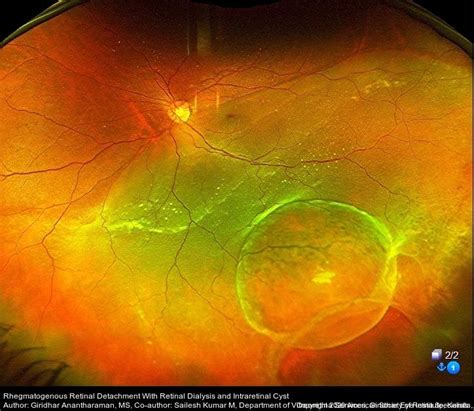It Is A Case Of Rhegmatogenous Retinal Detachment Reasonably Long