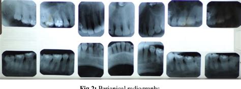 Figure 2 From Clinical Diagnosis And Treatment Of Infrabony Defects