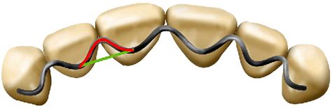 Figure 1 From Clinical Effectiveness Of Titanium Cad Cam Retainers From