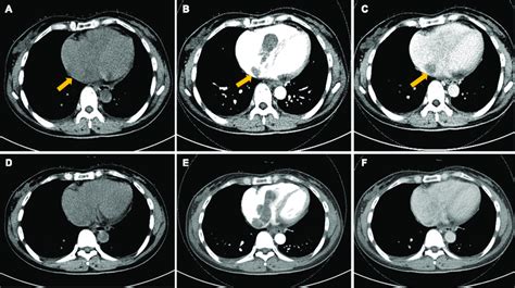 Axial Computed Tomography Ct Image Of The Heart A F Download