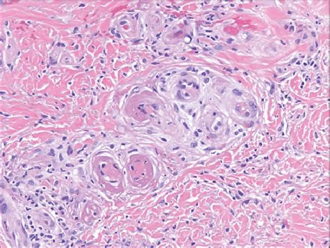 In Livedoid Vasculopathy Upper And Mid Dermal Capillaries Are Dilated Download Scientific