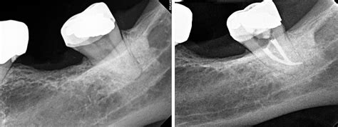 The Root Canal Blog C Shaped Molars
