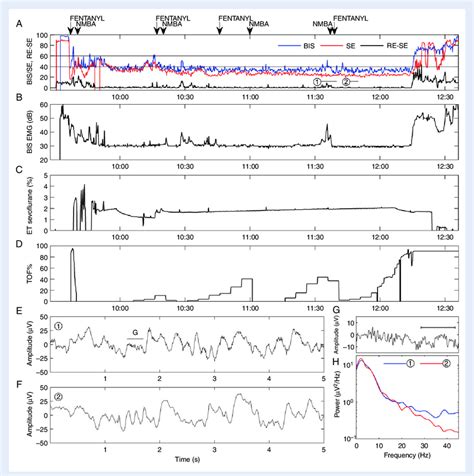 The Effect Of Emg Activation On Bis Bispectral Index® And Se State