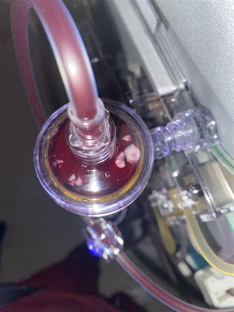 What Is The White Stuff In This Crrt Filter Pt Is On Crrt For