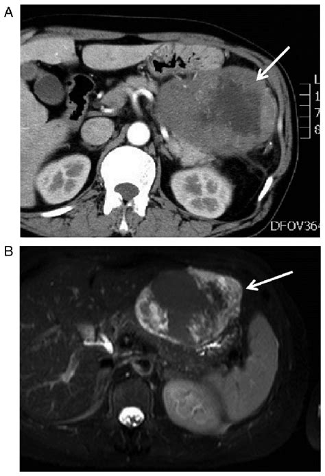 Radiological Characteristics Of Gists A Computed Tomography Scan Download Scientific Diagram