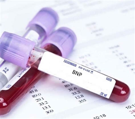 Bnp Blood Test Uses Bnp Blood Test Normal Range And Bnp For Heart Failure