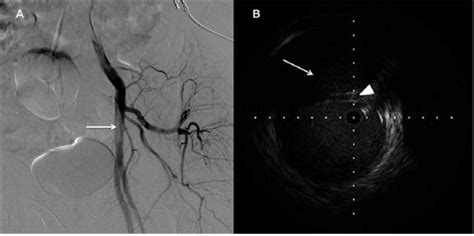 A Initial Angiography Shows Dissection With Visualized Intimal Flaps Download Scientific