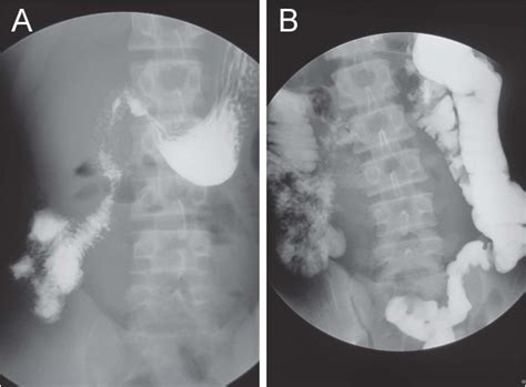 Gastrointestinal Contrast Studies A Upper Gastrointestinal Contrast