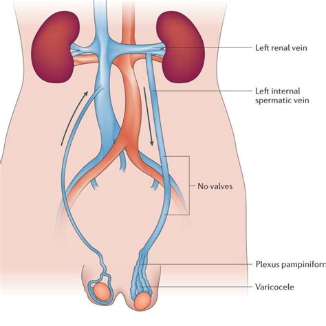 Varicocele Embolisation Radiology Wales