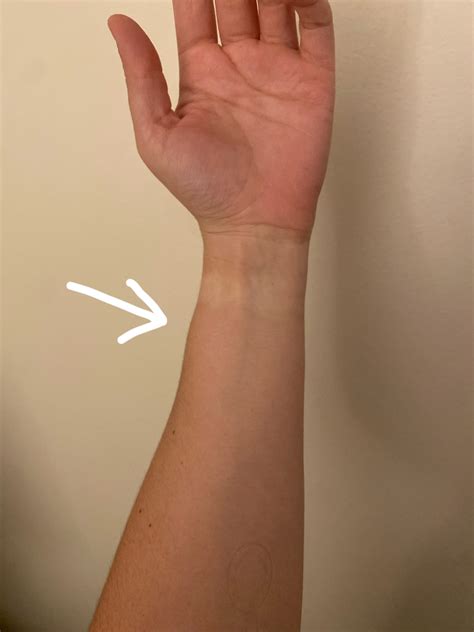 Soft Moveable Lump Deep In Arm What Is It Doesnt Present Like A Lipoma Follows Apl Muscle