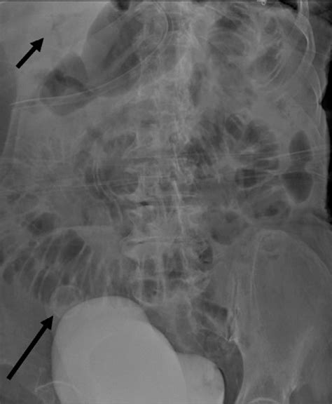 Figure 3 From Spontaneous Resolution Of Gallstone Ileus Followed By