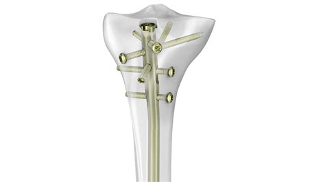 Intramedullary Rod Tibia