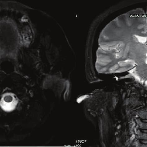 Mri Scan Showing The Lesion Lie In Posterior Border Of The Left Parotid Download Scientific