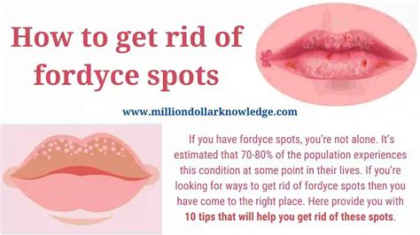 Fordyce Spots On Labia