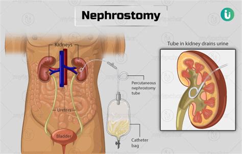 Nephrostomy Procedure Purpose Results Cost Price