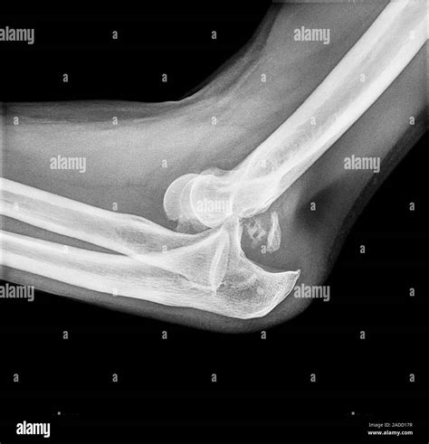 Dislocated Elbow X Ray Of The Elbow Of A 58 Year Old Man With A