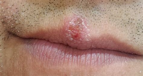 Lip Lesion Rdermatologyquestions