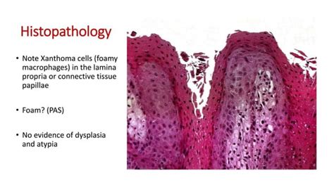 Squamous Papilloma And Verruciform Xanthoma Doctor Faris Alabeedi Msc