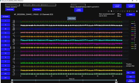 A Convolutional Autoencoder Framework For Ecg Signal Analysis Heliyon