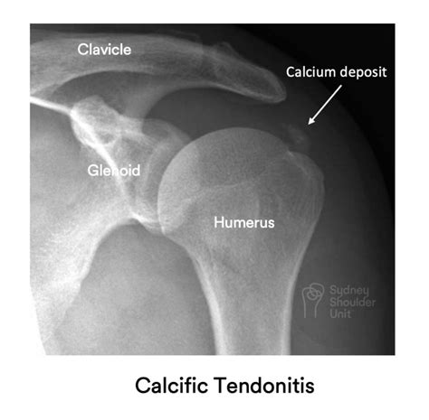 Calcification Of Joints Shoulder At Amanda Moretz Blog