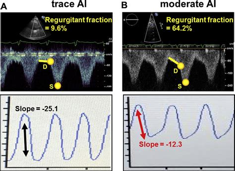 Figure 1 From Estimation Of The Severity Of Aortic Insufficiency By