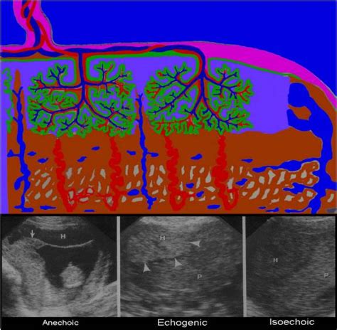 Ultrasound Of Placental Hematoma And Abruption