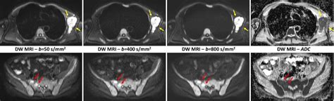 Figure 2 From Whole Body Functional Mri And Petmri In Multiple Myeloma