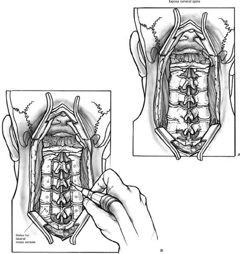 Posterior Cervical Laminectomy And Fusion Neupsy Key
