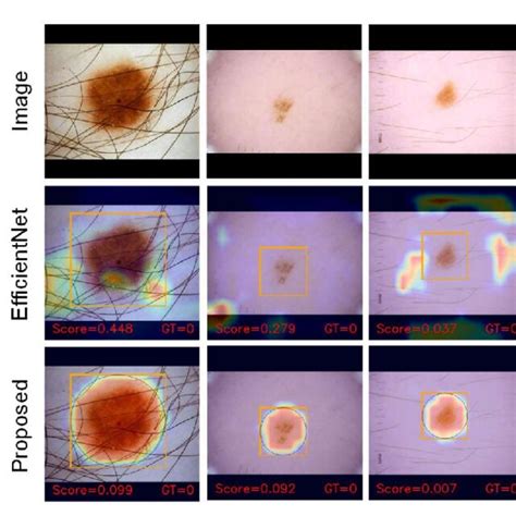 Overlays Of The Class Activation Map Cam On The Test Benign Lesion Download Scientific