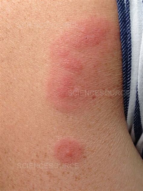 Bed Bug Bites On Arm Stock Image Science Source Images
