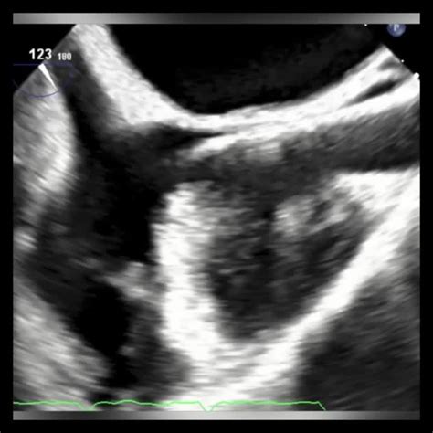 Saurabh Sanon Md Facc On Linkedin Simplified Excision Of Atrial