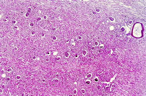 Diffuse Proliferative Glomerulonephritis Light Micrograph Stock
