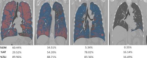 Ai Algorithm Can Predict Severity Progression Of Copd Auntminnie