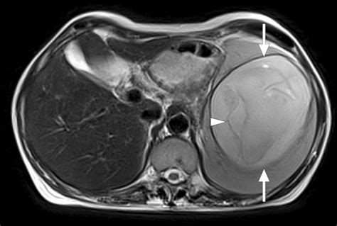 Cross Sectional Imaging Findings Of Splenic Infections Is Differential