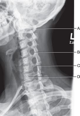 Cervical Spine Oblique RPO Diagram Quizlet