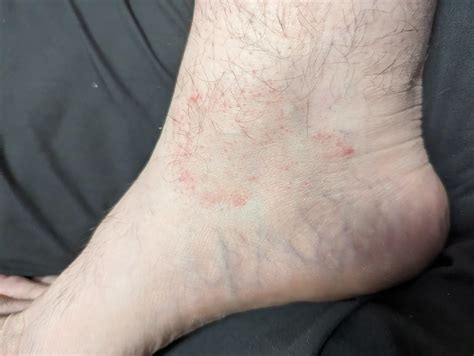 Curious About This Rashy Mark On My Ankle R Dermatologyquestions