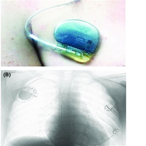 A Active Fixation Permanent Pacemaker Lead And Externalized Permanent