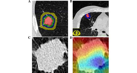 Region Of Interest Segmentation And Feature Extraction A The Tumor On Download Scientific