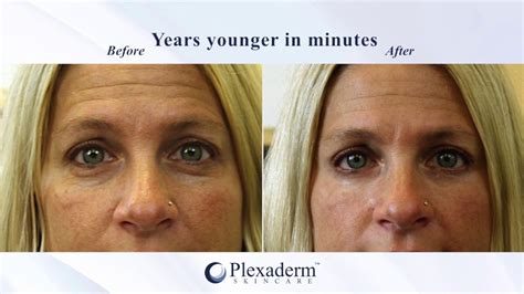 Plexaderm Before And After Transformation Youtube